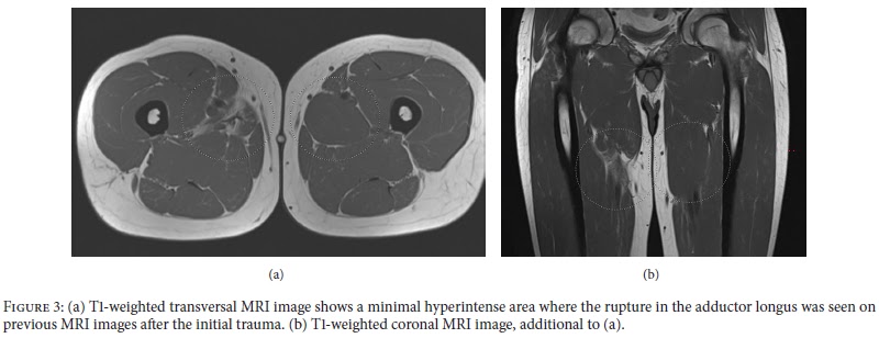 Fisioinforma: Um caso raro de rutura do Músculo Longo do Adutor