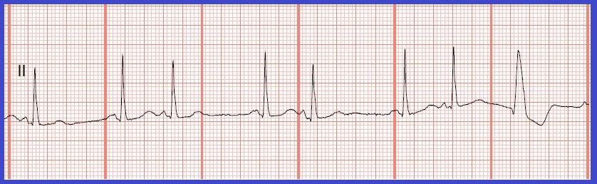 EKG Rhythm Strip Quiz 138