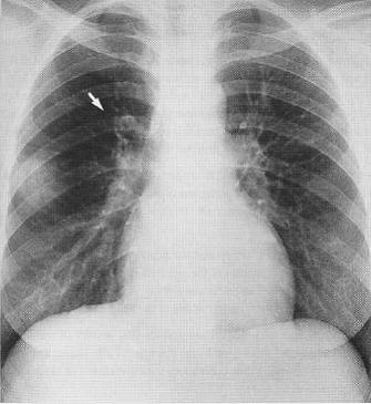 imaging of rontgen: BELAJAR BACA FOTO THORAX