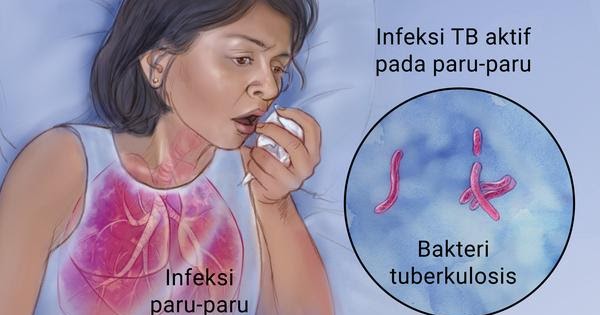 6 Cara Pencegahan penyakit batuk tuberculosis TBC