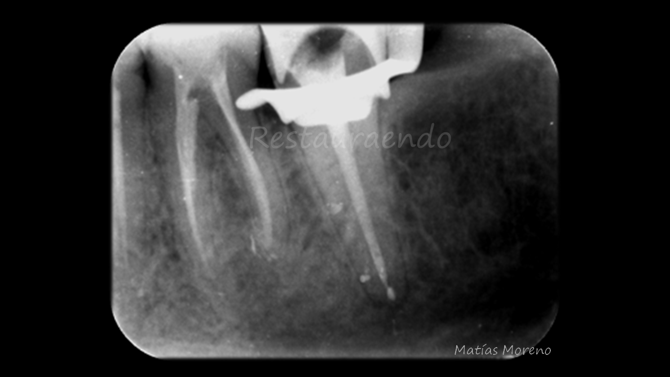 Máster en Odontología Restauradora y Endodoncia: Tratamiento de ...