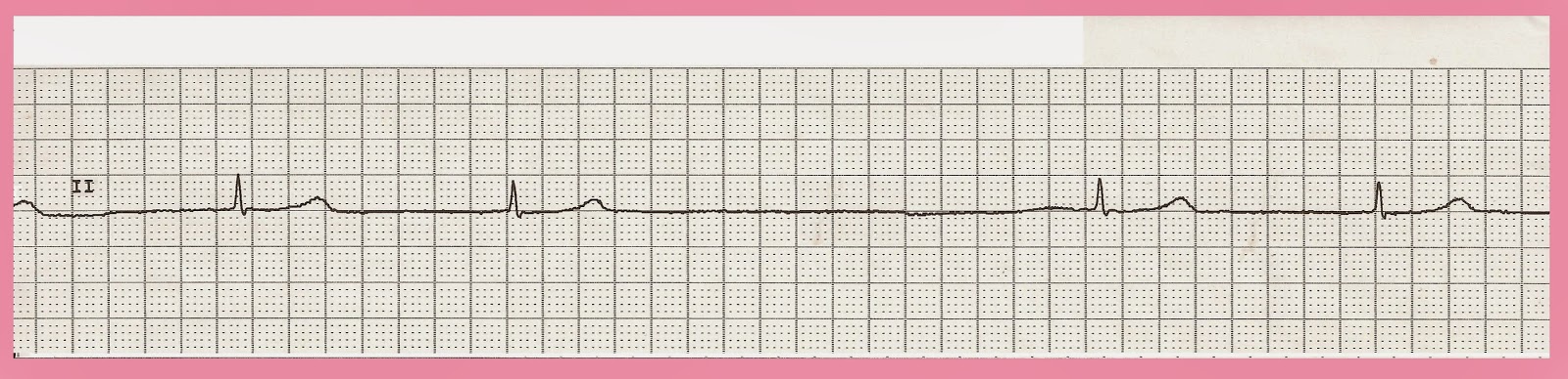 Practice EKG Strips 396