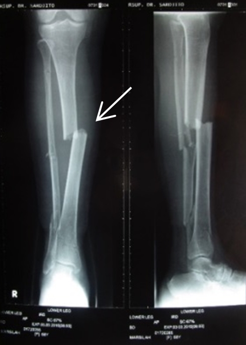 Orthopaedi Knowledges: MANAGEMENT OF LONG BONE FRACTURES