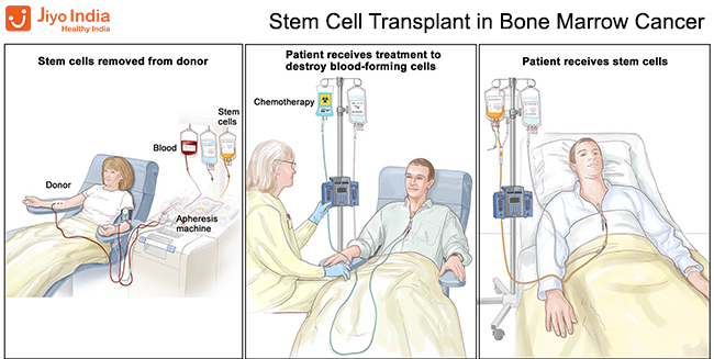 Bone Marrow Cancer: Symptoms, Treatment, Causes, and More