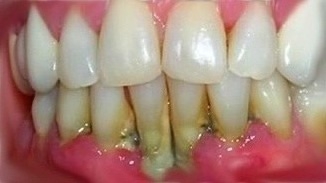 odontología preventiva: CALCULO DENTAL