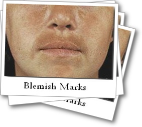 Tips And Remedies: Tips 4r Age spots/Blemishes
