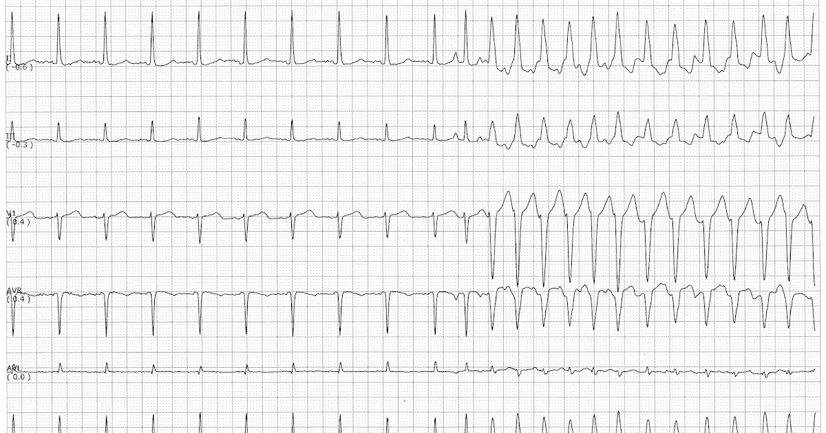 Float Nurse: Sinus Rhythm Changing to VT or ST with Aberrancy