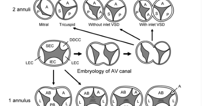 Pedi cardiology: AVSD terminology