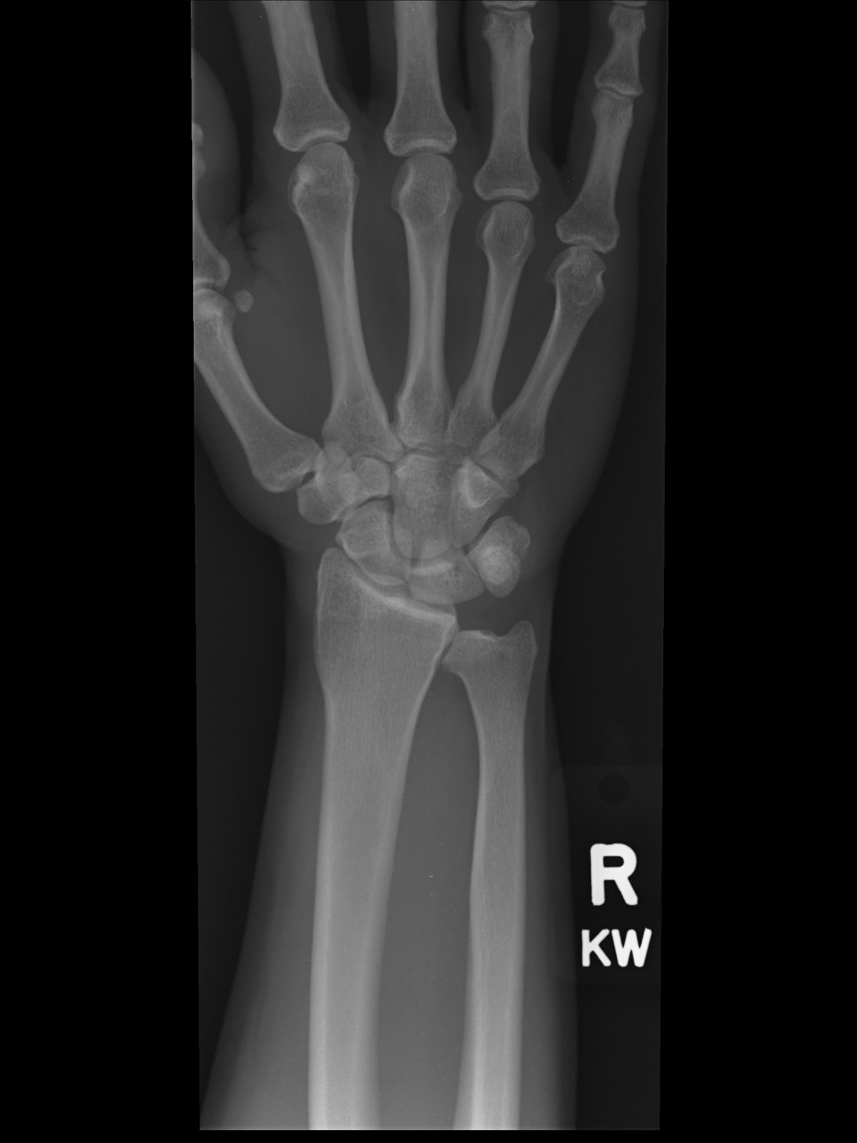 Musculoskeletal Radiology Ulnar Variance musculoskeletal-radiology-ulnar-variance