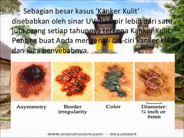 kanker kulit : Gejala dan Pengobatannya