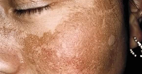 HOMOEO HEALTH LINE: CHLOASMA/ MELASMA & HOMOEOPATHIC TREATMENT