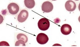 FICHERO HEMATOLOGIA : Eritrocito hipercrómico