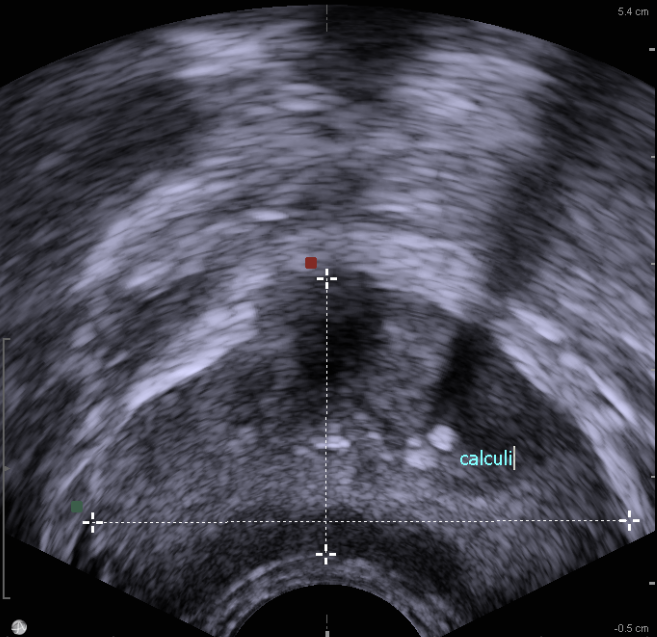 周智原 | 泌尿專科醫師 ｜Chih-Yuan Chou, MD.: 攝護腺結石 ( Prostate Calculi )