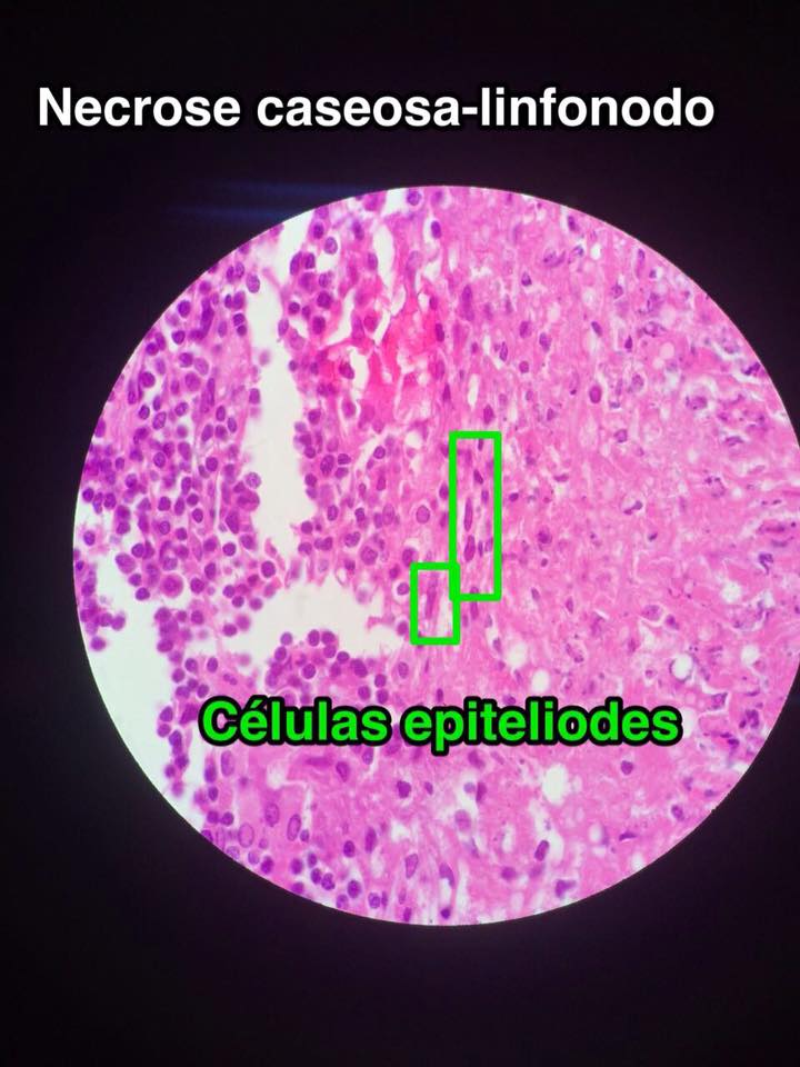 HISTOLOGIA90: TIPOS DE NECROSE
