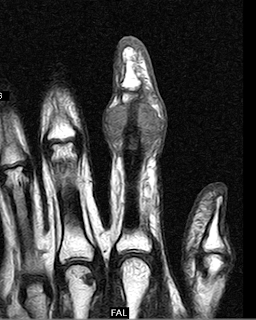 GCT of Tendon Sheath-MRI - Sumer's Radiology Blog