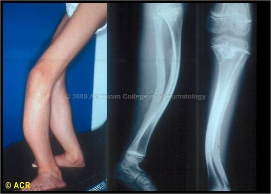 My Note: Fakta tentang Osteogenesis Imperfect