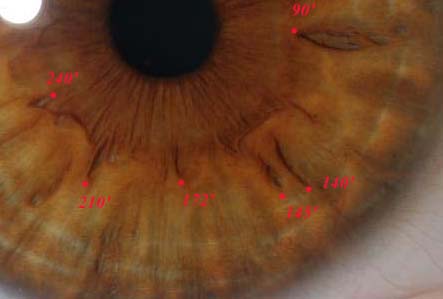 Modern & Multidimensional Iridology: Lacunae at Pupillary Zone ...