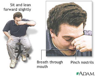 treatment of nose bleed [Epistaxis] | Epistaxis