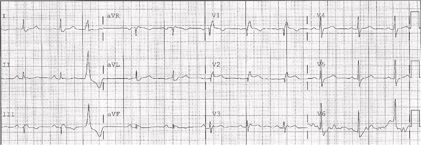 Dr. Smith's ECG Blog: Right Bundle Branch Block with ST elevation in V2 ...