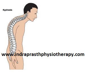 INDRAPRASTH PHYSIOTHERAPY CENTRE: KYPHOSIS