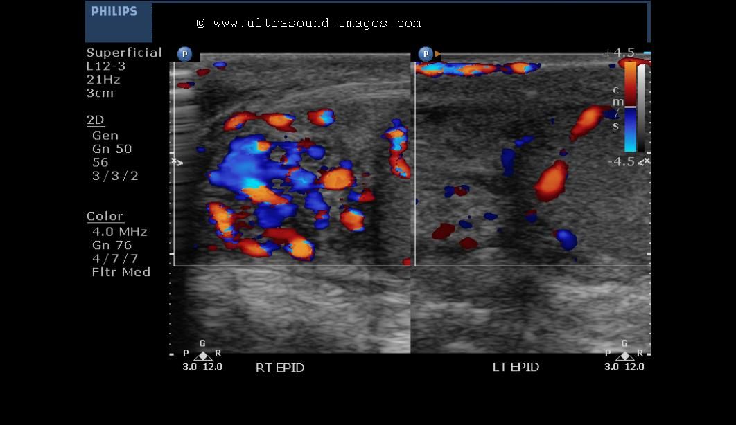 Epididymitis Ultrasound