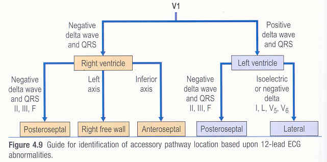 Cardiology window: WPW syndrome, left posterior pathway, intermittent ...