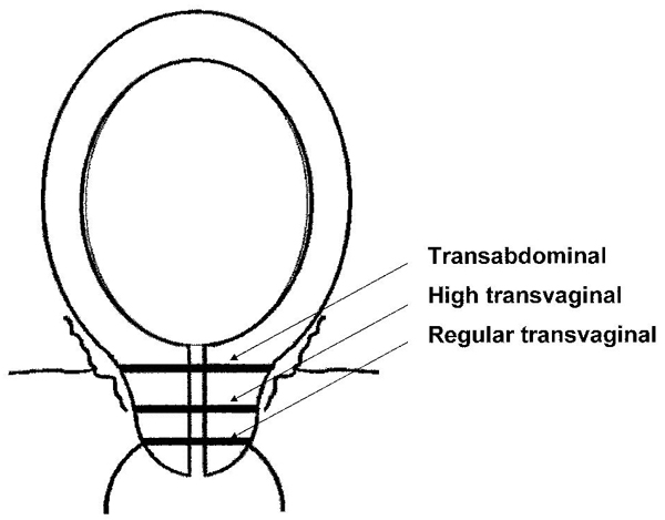 Mi experiencia con un cerclaje trans-abdominal: 2017