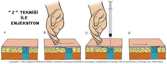 INTRAMUSKULER ENJEKSİYON UYGULAMASI: ENJEKSİYON UYGULAMA TEKNİKLERİ