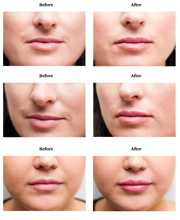 NURU THE LIGHT: LIP FILLERS!!!