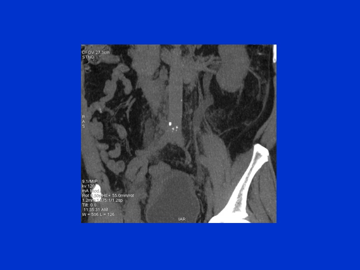 Kuching Urology古晉秘尿專科: Lower urinary tract symptoms LUTS and prostate ...