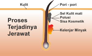Kulit cantik dengan shaklee: Punca-punca jerawat yang perlu anda tahu