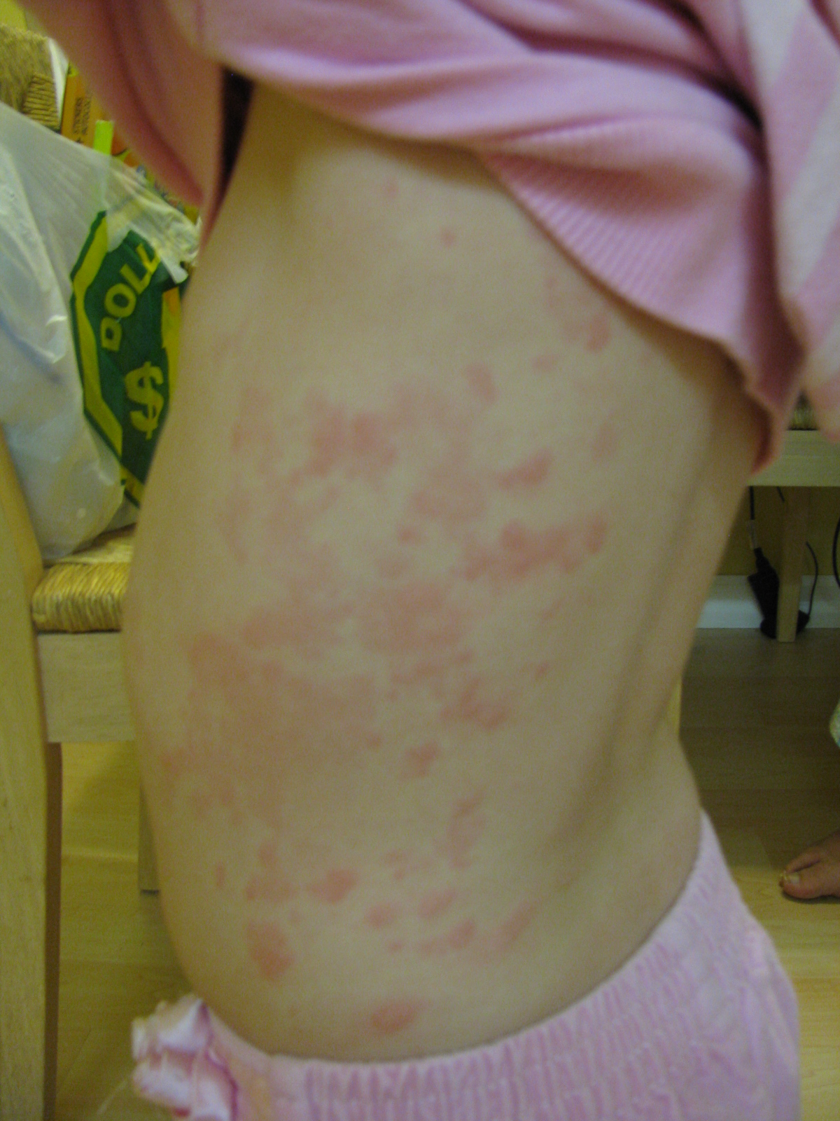 The Hardest Quest: Fifth Disease