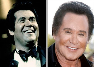 Wayne Newton Plastic Surgery