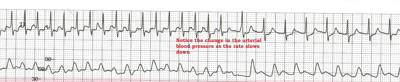 EKG Rhythm Strips of Unstable SVT with Arterial Blood Pressure Waveform
