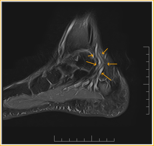 Tarsal Tunnel Varicosities: MRI - Sumer's Radiology Blog
