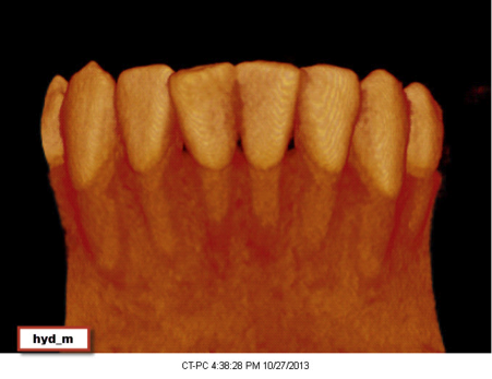 The POPA Blog: A New Syndrome for Dentistry: Dental Space Deficiency ...