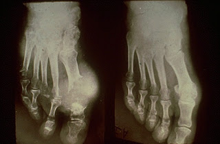 Tips, Petua & Cara Alam Perkahwinan: Panduan Pemakanan Pesakit Gout