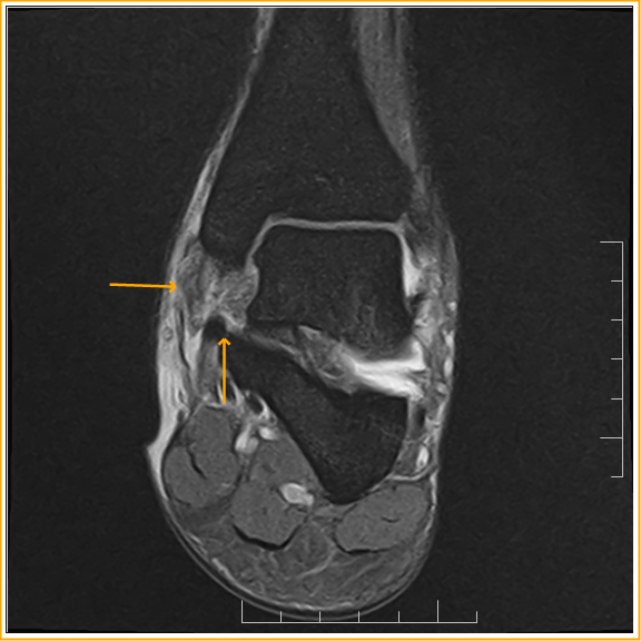 Deltoid Ligament Disruption : MRI - Sumer's Radiology Blog