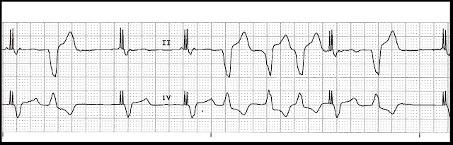 Pacemaker av sequential - apoturk