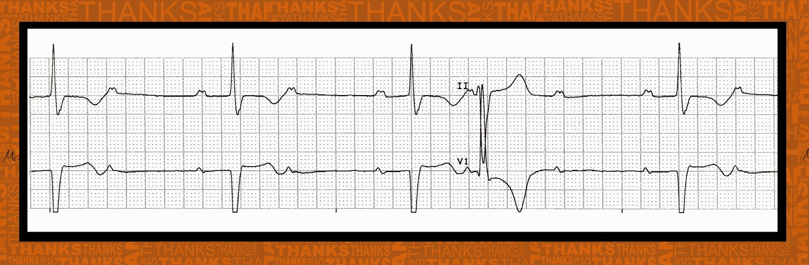 Practice EKG Strips 360
