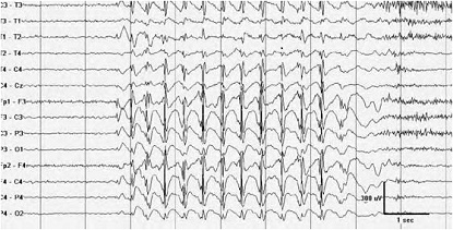 MCQ. Electoencephalography (EEG) ~ Nursing Path