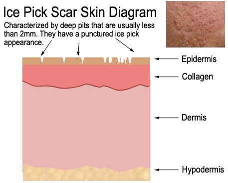 Clique Clinic: A Simple Guide to Acne Scars