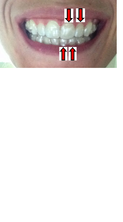 My Invisalign Journey