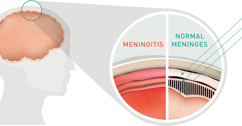 Pediatrics Notes: Meningitis - How to Diagnose it
