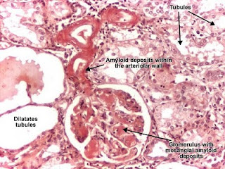 Histology and Explanation of Amyloidosis kidney | MEDICAL CHOICES