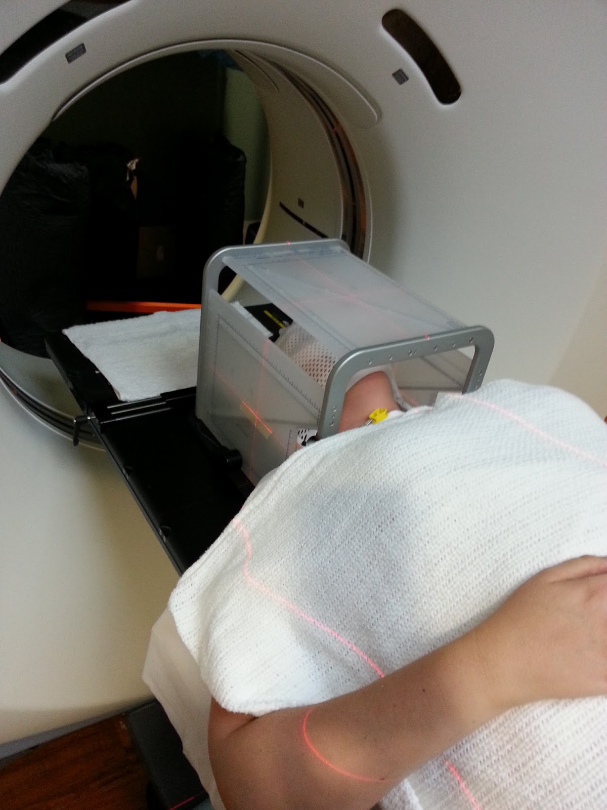 Team S - Living with Stage IV Breast Cancer: Radiation Pictures and Video