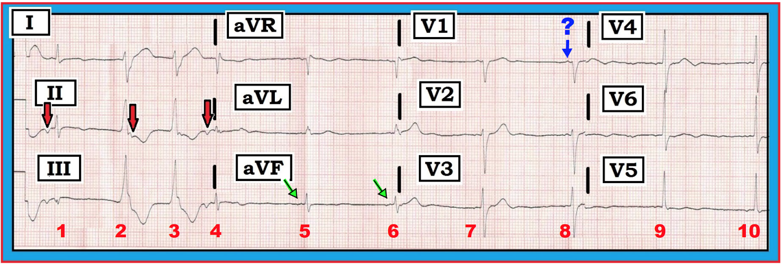 ECG Interpretation: ECG Blog #107 — Ventricular Echo?