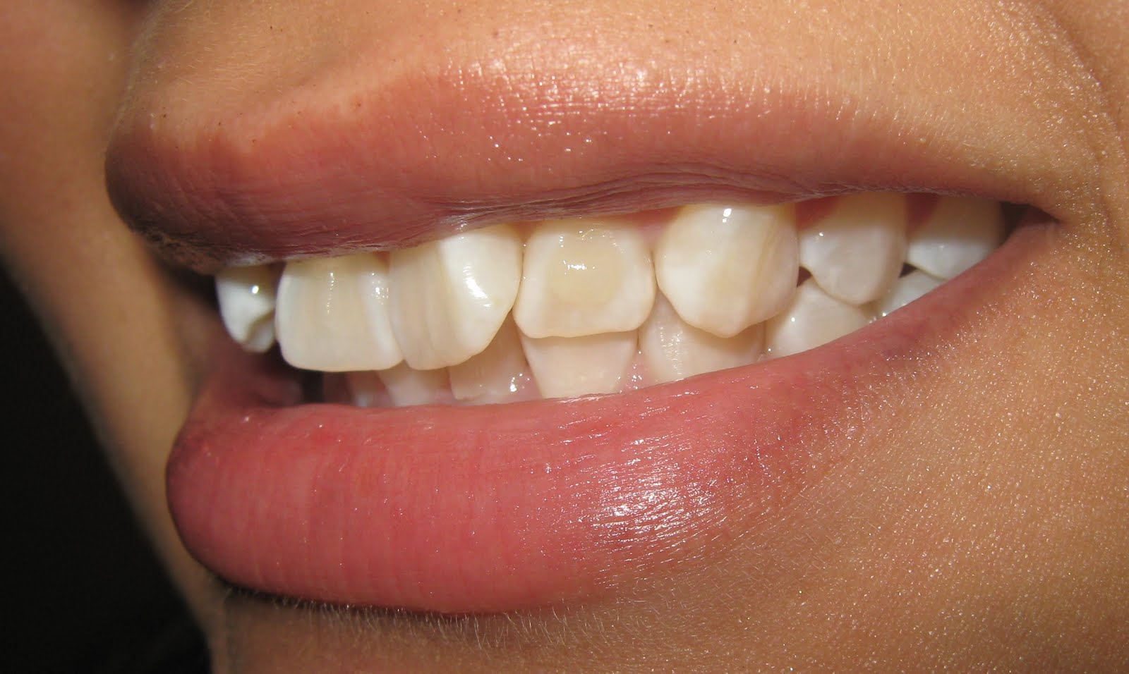 Br@ndy's Invisalign Journey: Tray 3