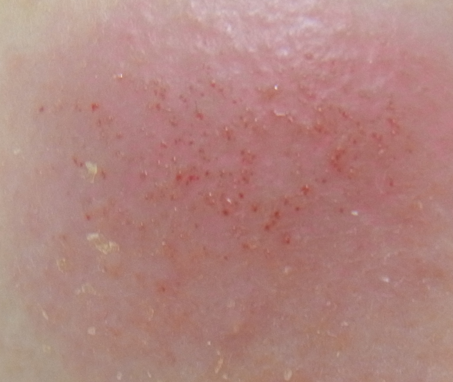 It's Only Skin Deep: Ooze vs Blood?