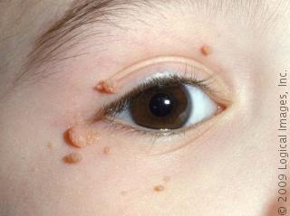 SEBAIKNYA KITA TAHU: Cara Alami Menghilangkan Kutil Di Kulit